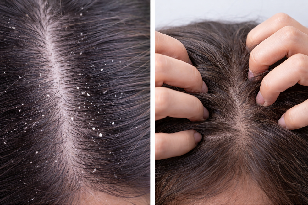 Dandruff Isn’t Just Flakes: What Your Scalp Is Trying to Tell You – The ...